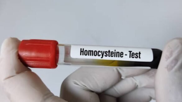 Homocysteine Testing and its Use in Treating Fertility Issues ...